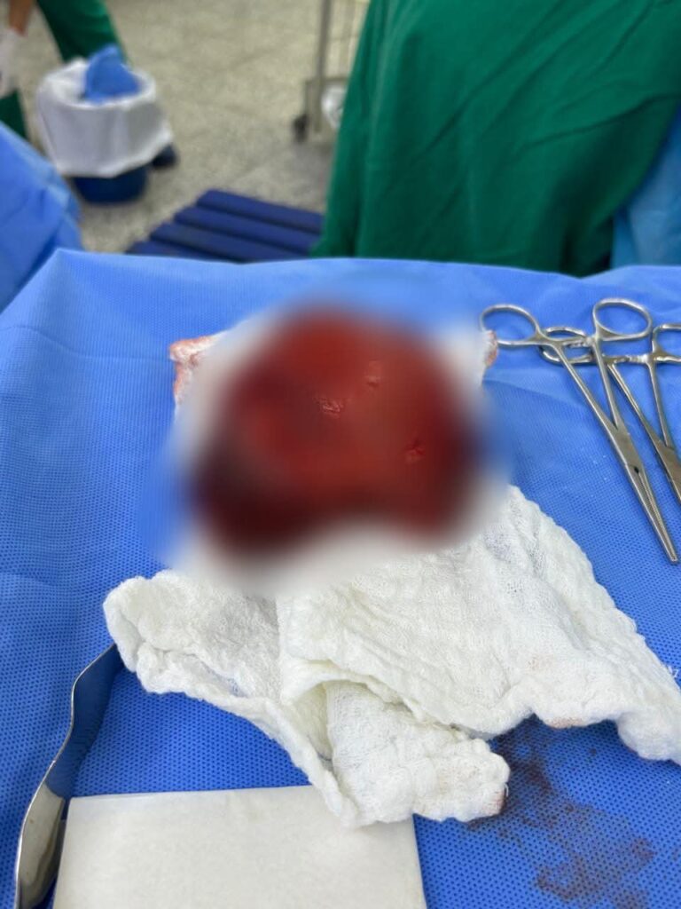 Popular / Extraen feroz tumor cervical a una recién nacida en Clínicas